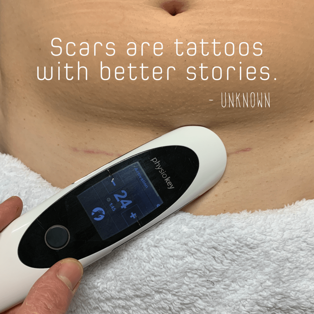 Litteken behandeling met key therapie (physiokey of medkey) - Key Health